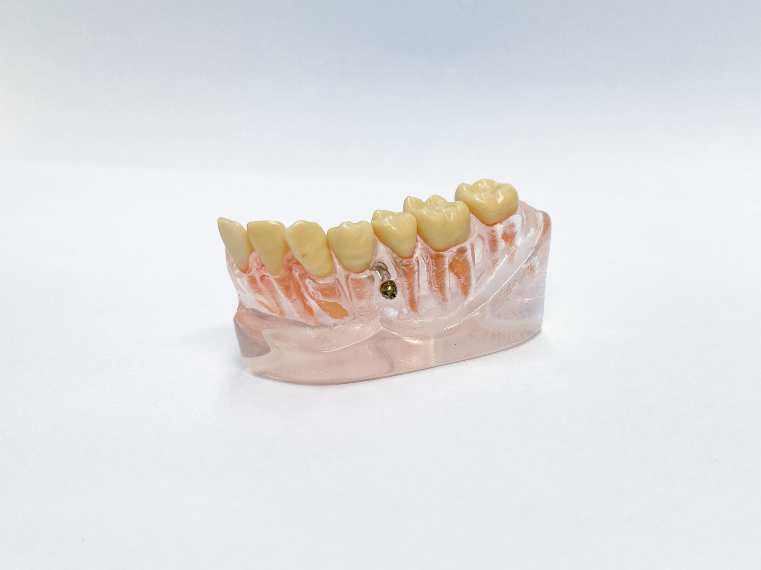 Minipins (mini screws or orthodontic mini implants) - Isarsmile